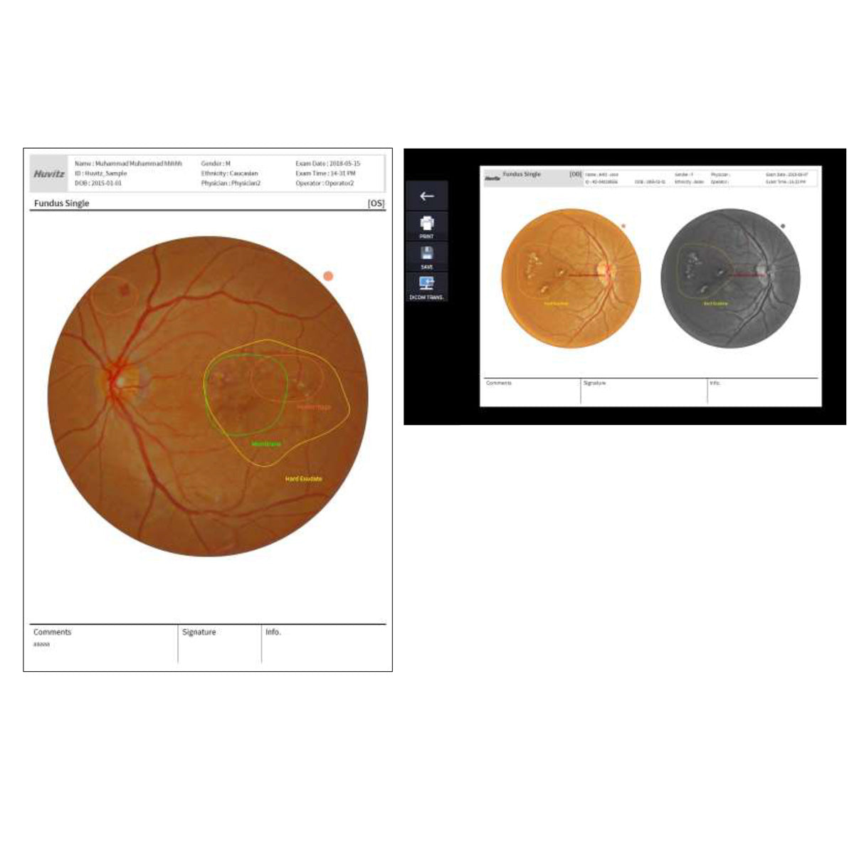 Software de Inteligencia Artificial Huvitz AI Fundus | US Ophthalmic ...
